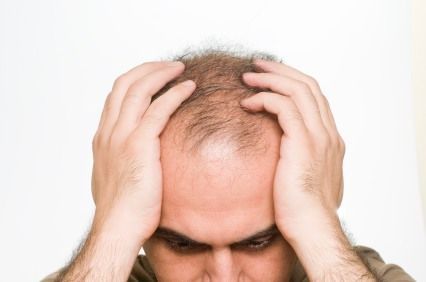 Propecia Side Effects Get New Name: Post-Finasteride Syndrome (PFS)
