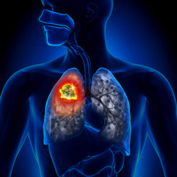 Asbestos Exposure and Related Lung Diseases