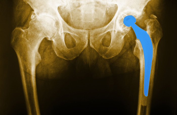 Metal on Metal Hip Implant Problems