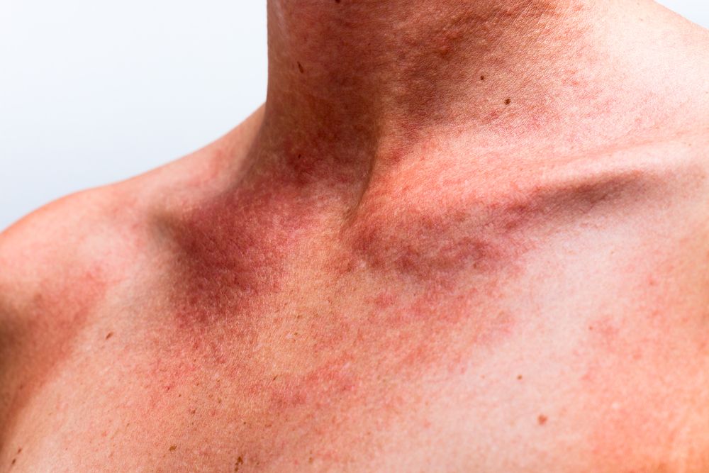 Skin Reactions To Azithromycin Top Class Actions