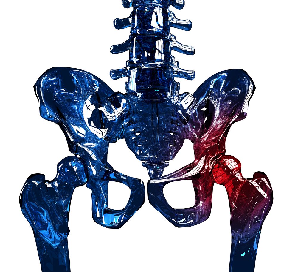Defects Caused Hip Replacement Surgery Failure, Couple Says - Top Class ...