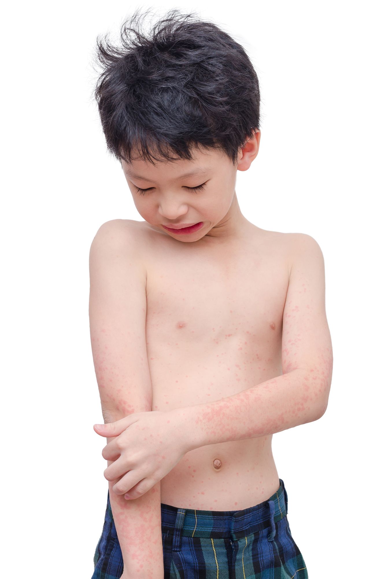 Zithromax Skin Side Effects in Children