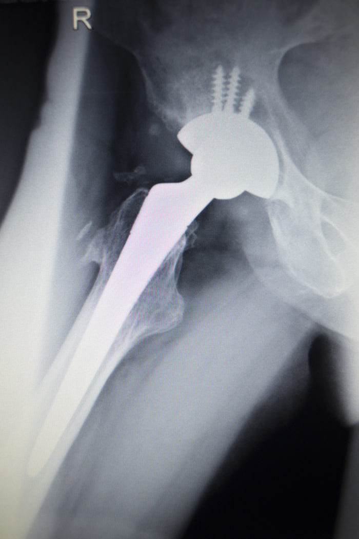 Biomet M2a Magnum Hip Implant Lawsuit Spurred by Complications - Top ...