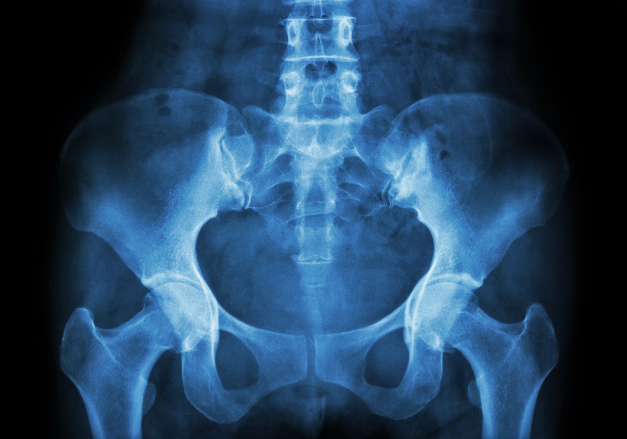 DePuy Lawsuit Says ASR Hip Implant is Defective - Top Class Actions