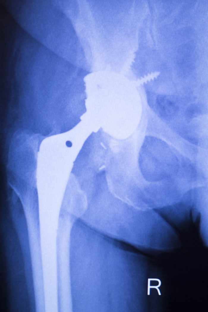 Plaintiff’s Experience of Prosthetic Failure Sparks DePuy Pinnacle ...