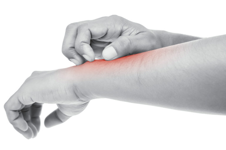 Deadly Skin Rash from Lamictal Could Be Stevens Johnson Syndrome