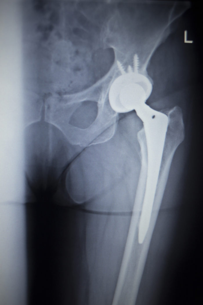 New DePuy Hip Implant Lawsuit Joins MDL in Dallas - Top Class Actions