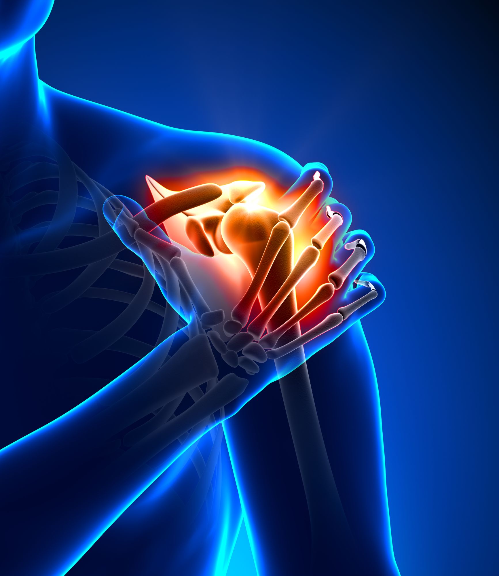Plaintiff Benefits from Biomet Reverse Shoulder Settlement