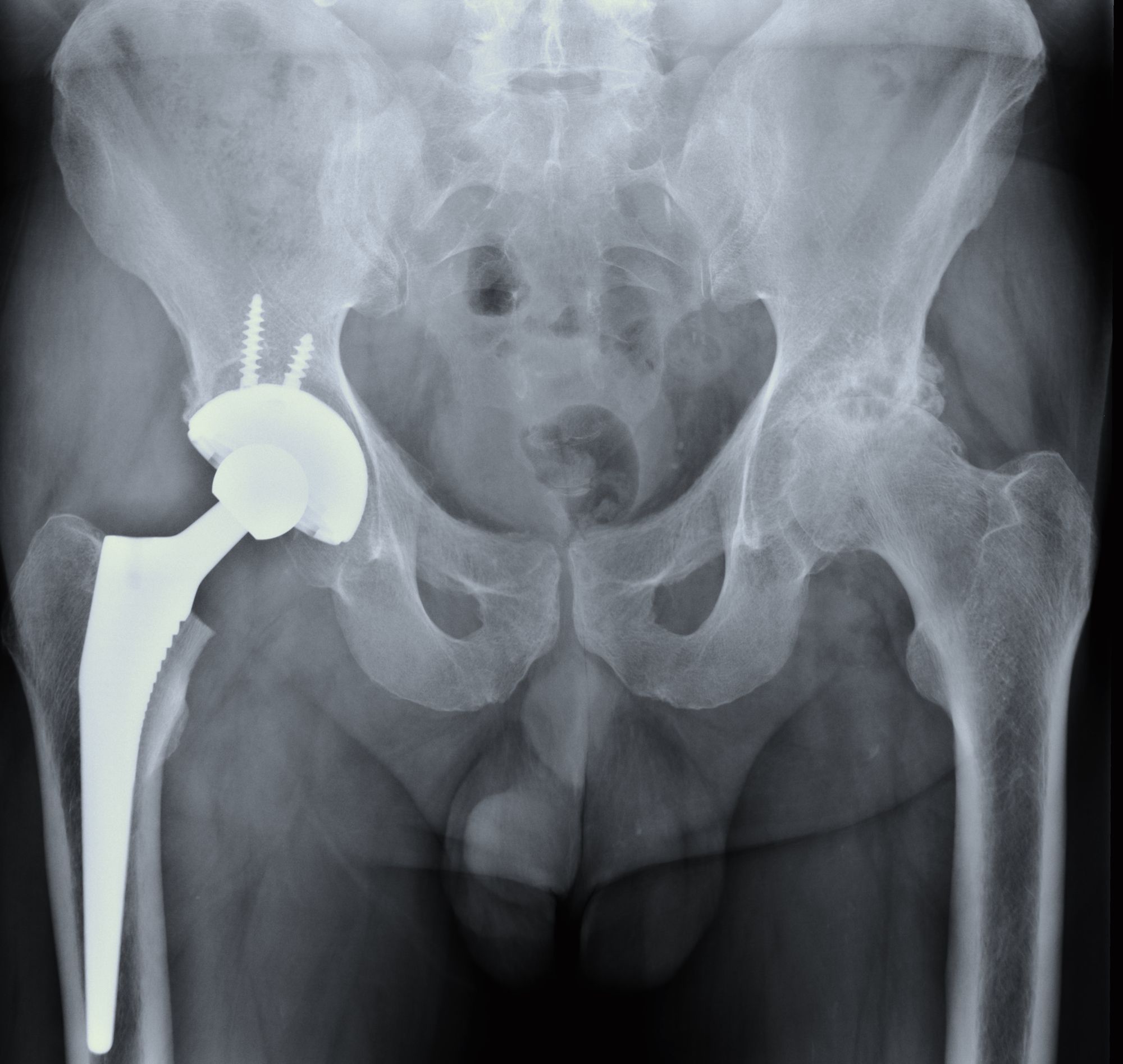 LFIT V40 Femoral Head Lawsuit Filed over Alleged Defects - Top Class ...