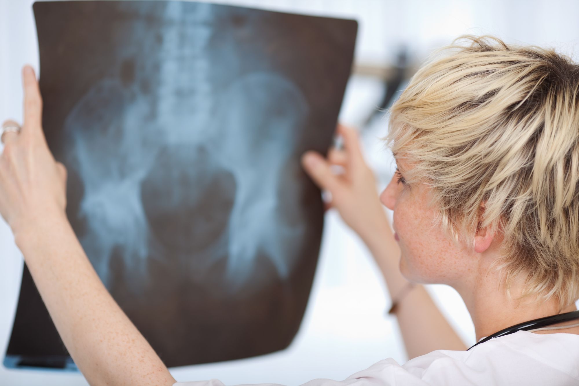 Hip Recall by Stryker Follows Reports of Numerous Complications - Top ...
