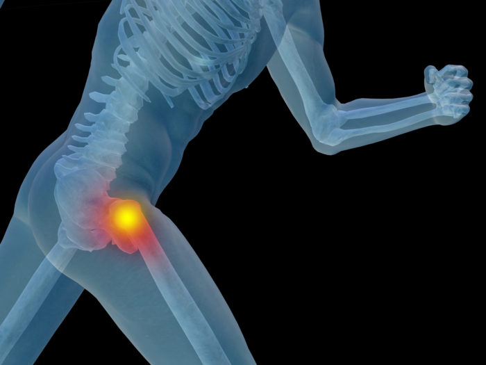 Pinnacle Hip Implant Patients Report Needing Revision Hip Surgery