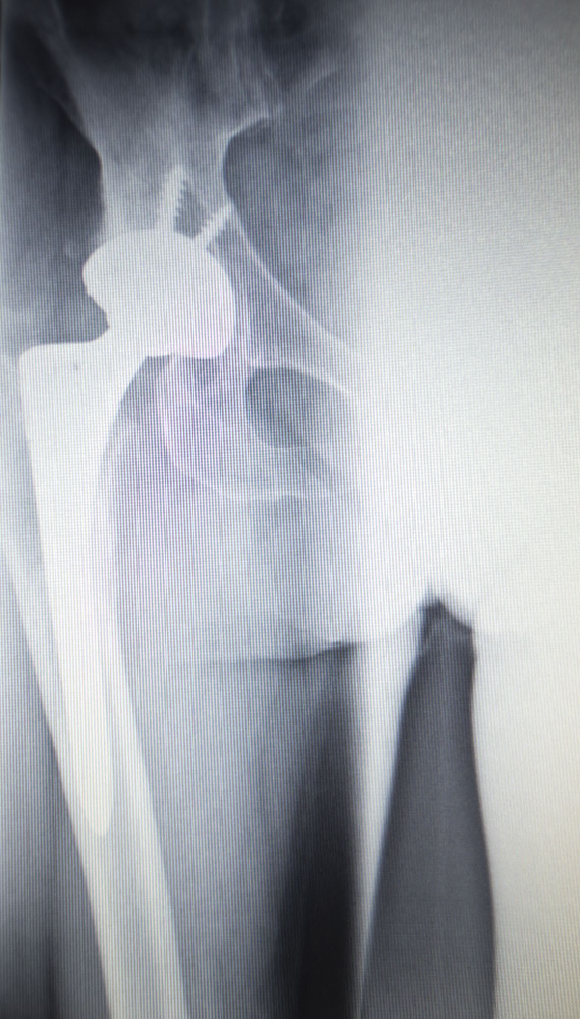 DePuy ASR Hip Recall Affects Thousands of Devices - Top Class Actions