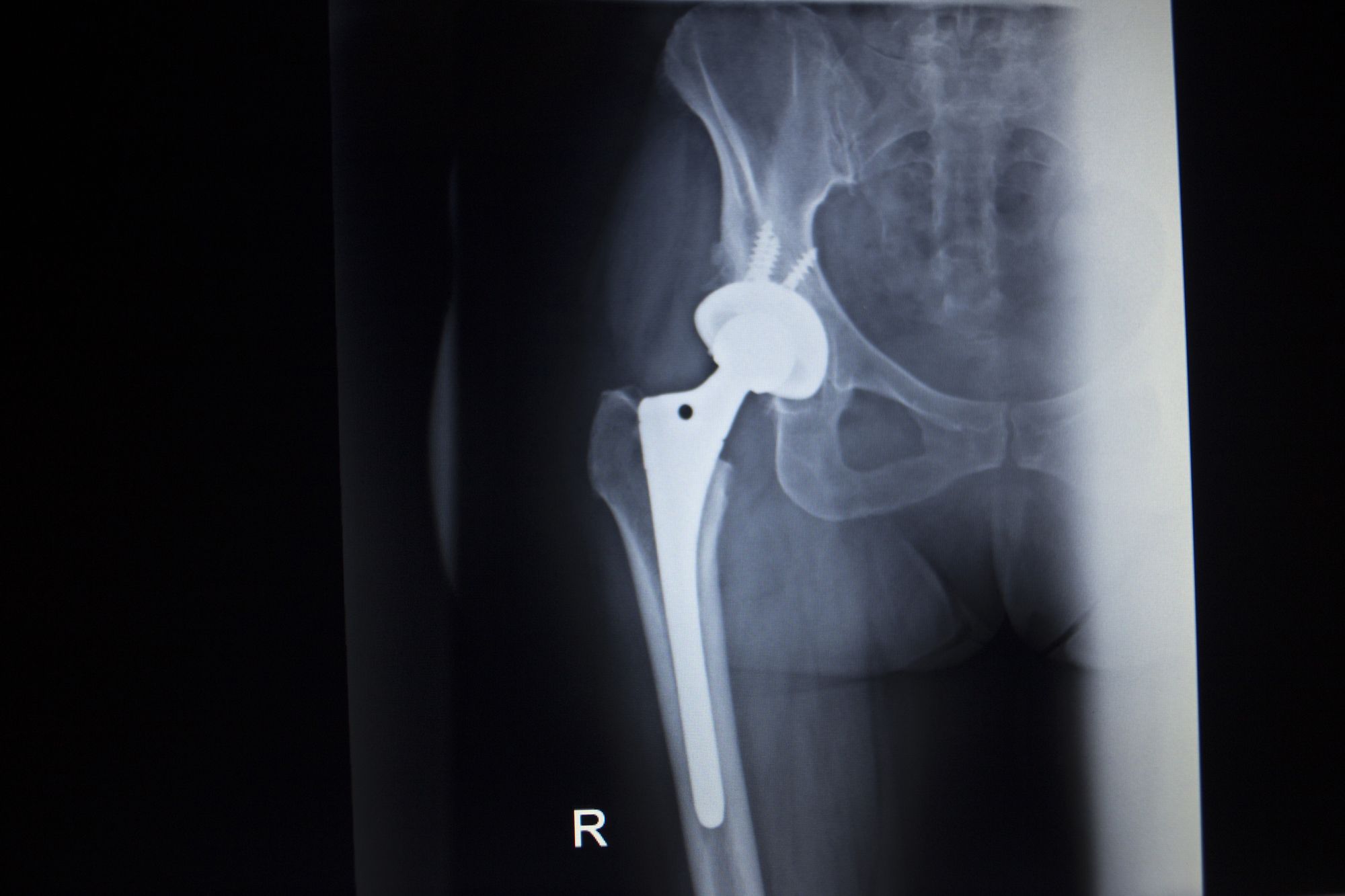 Hip Revision Surgery May Qualify for DePuy Hip Recall Compensation ...