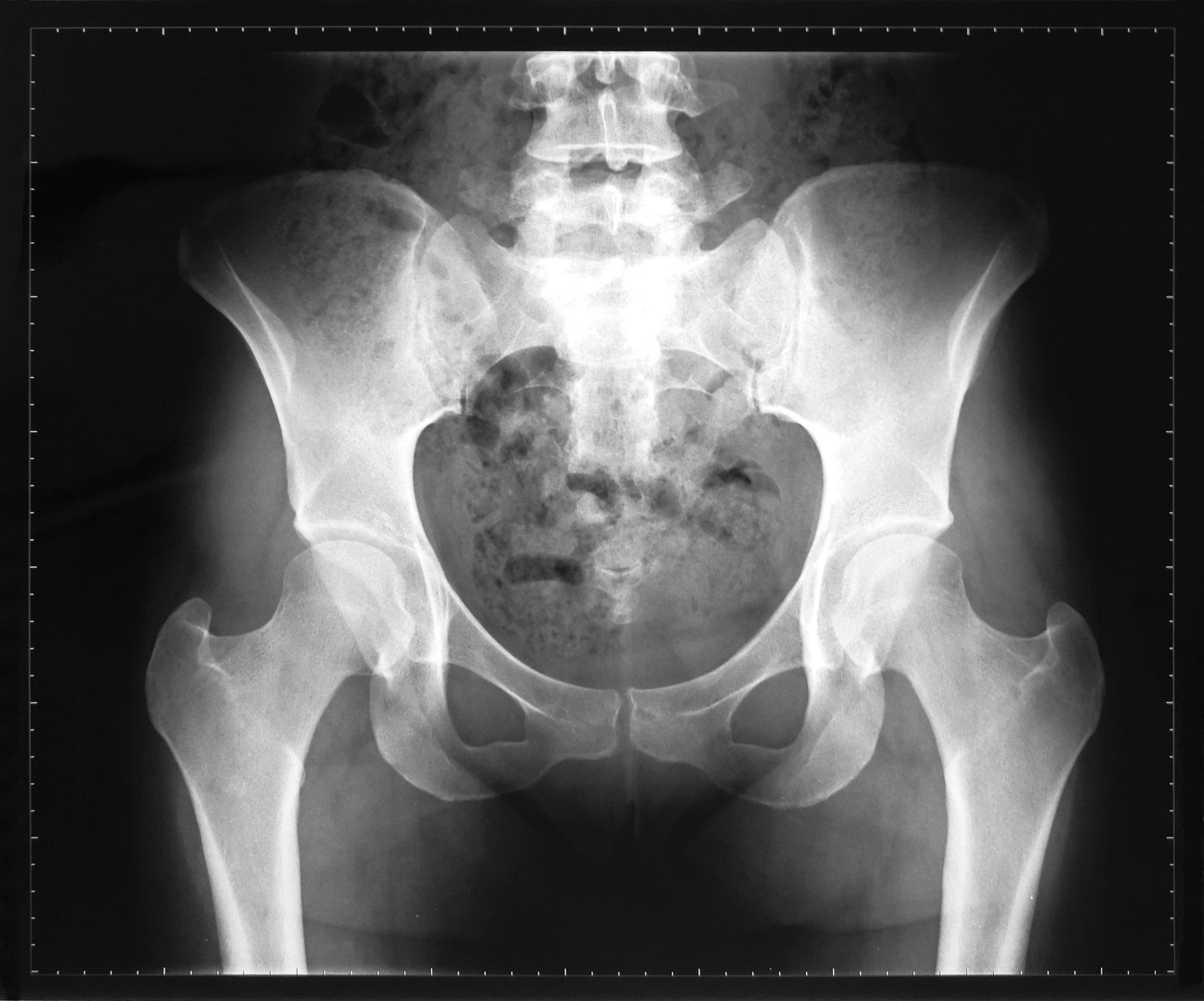 Woman Files Stryker Hip Implant Lawsuit Against Howmedica Osteonics ...