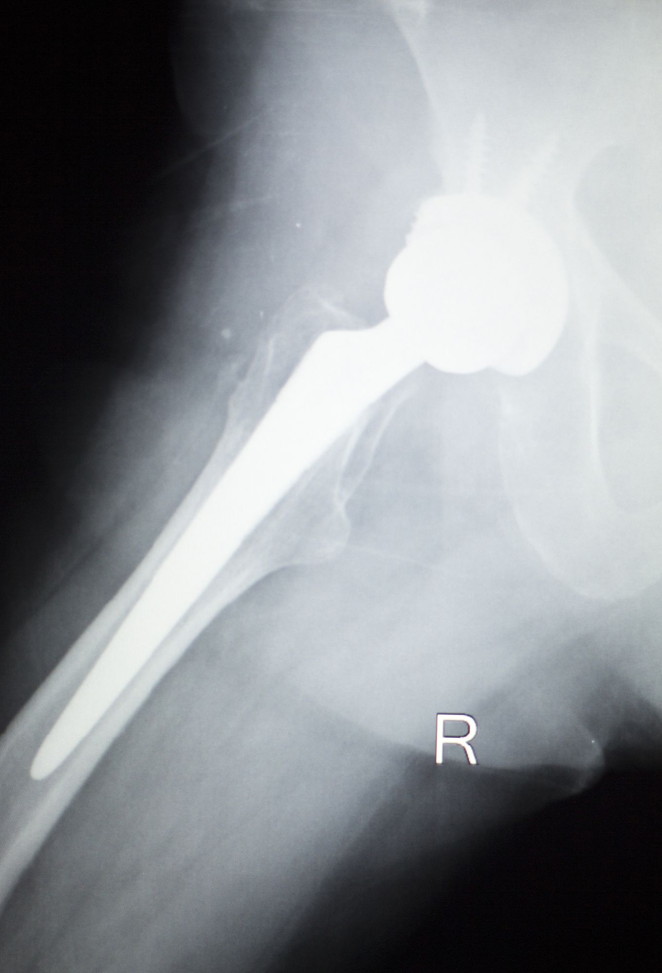 DePuy ASR Hip System May Require Early Revision Surgery - Top Class Actions