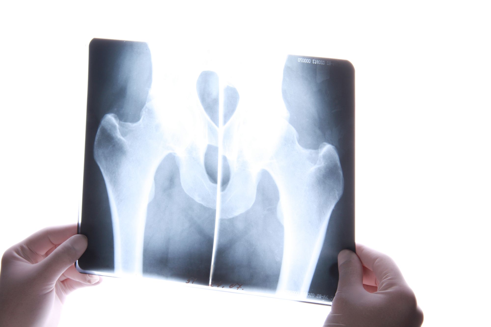 DePuy Pinnacle Hip Complications Lawsuit Filled over Early Revision ...