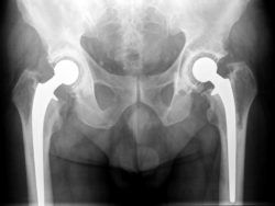 Lawsuit Takes Aim at Biomet Magnum M2a Hip System - Top Class Actions