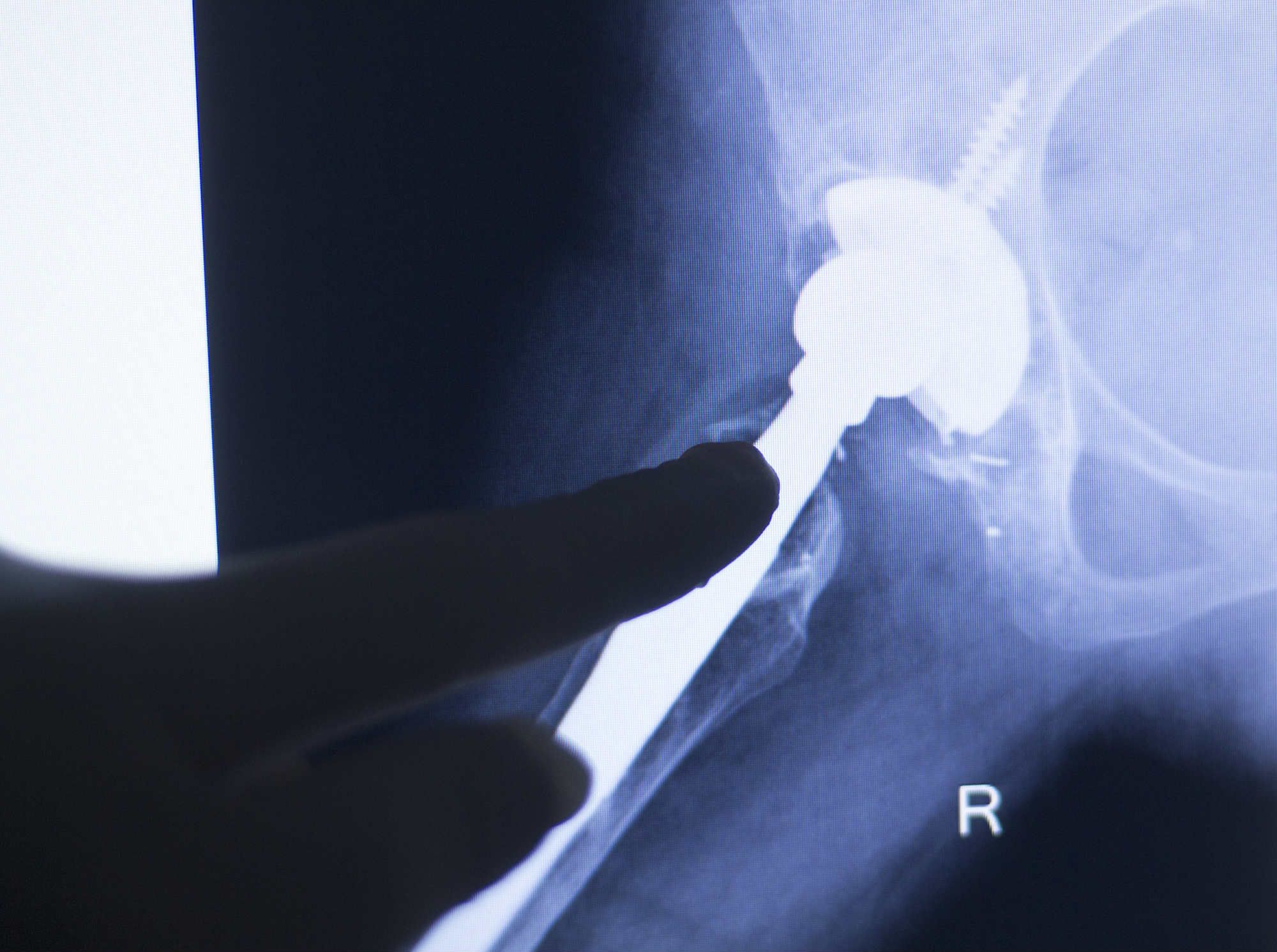 Couple Files New Pinnacle Hip Implant Failure Lawsuit