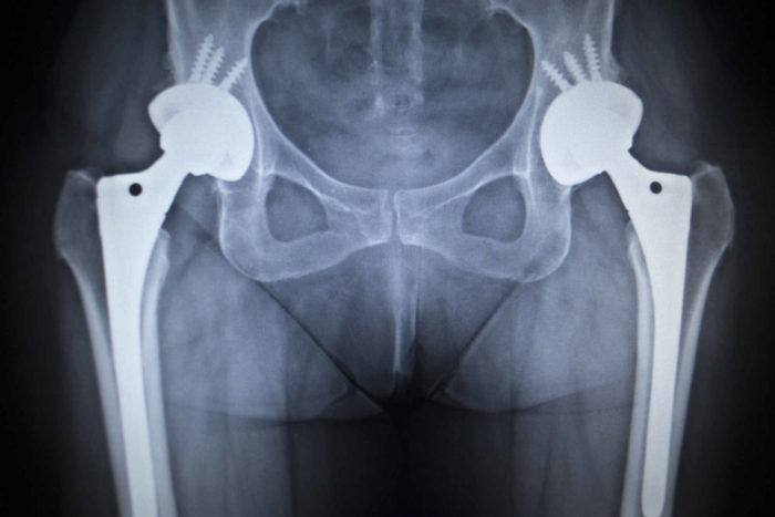 Pinnacle Acetabular Cup System Allegedly Causes Bone Deterioration in ...