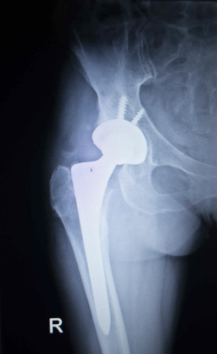 DePuy Pinnacle Hip Implant Lawsuit Claims Hip Replacement Releases ...