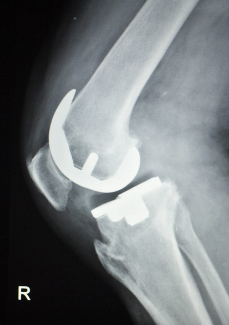 Component of Zimmer Knee Replacement Devices Part of 12,000-Unit Recall