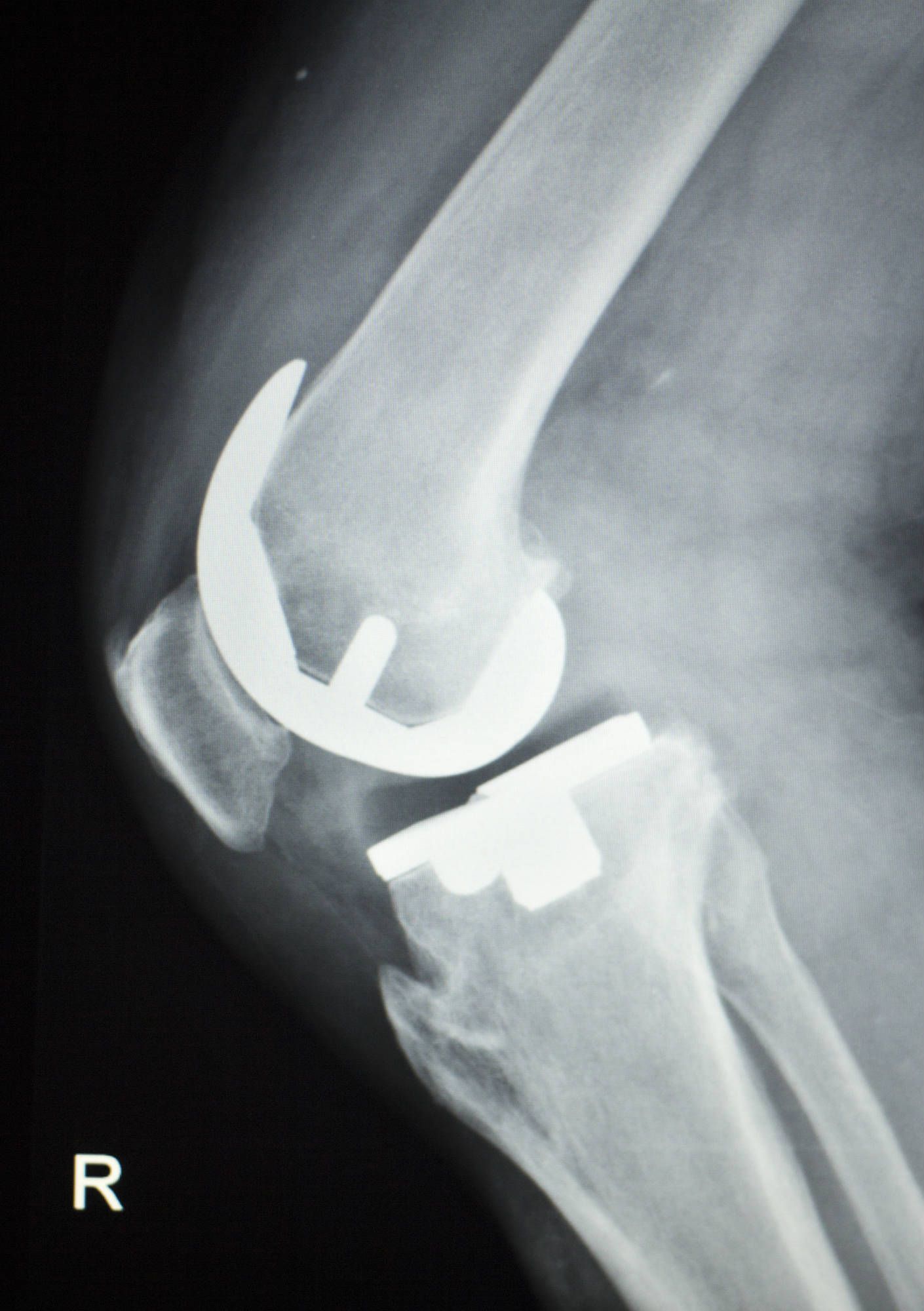 Component of Zimmer Knee Replacement Devices Part of 12,000-Unit Recall