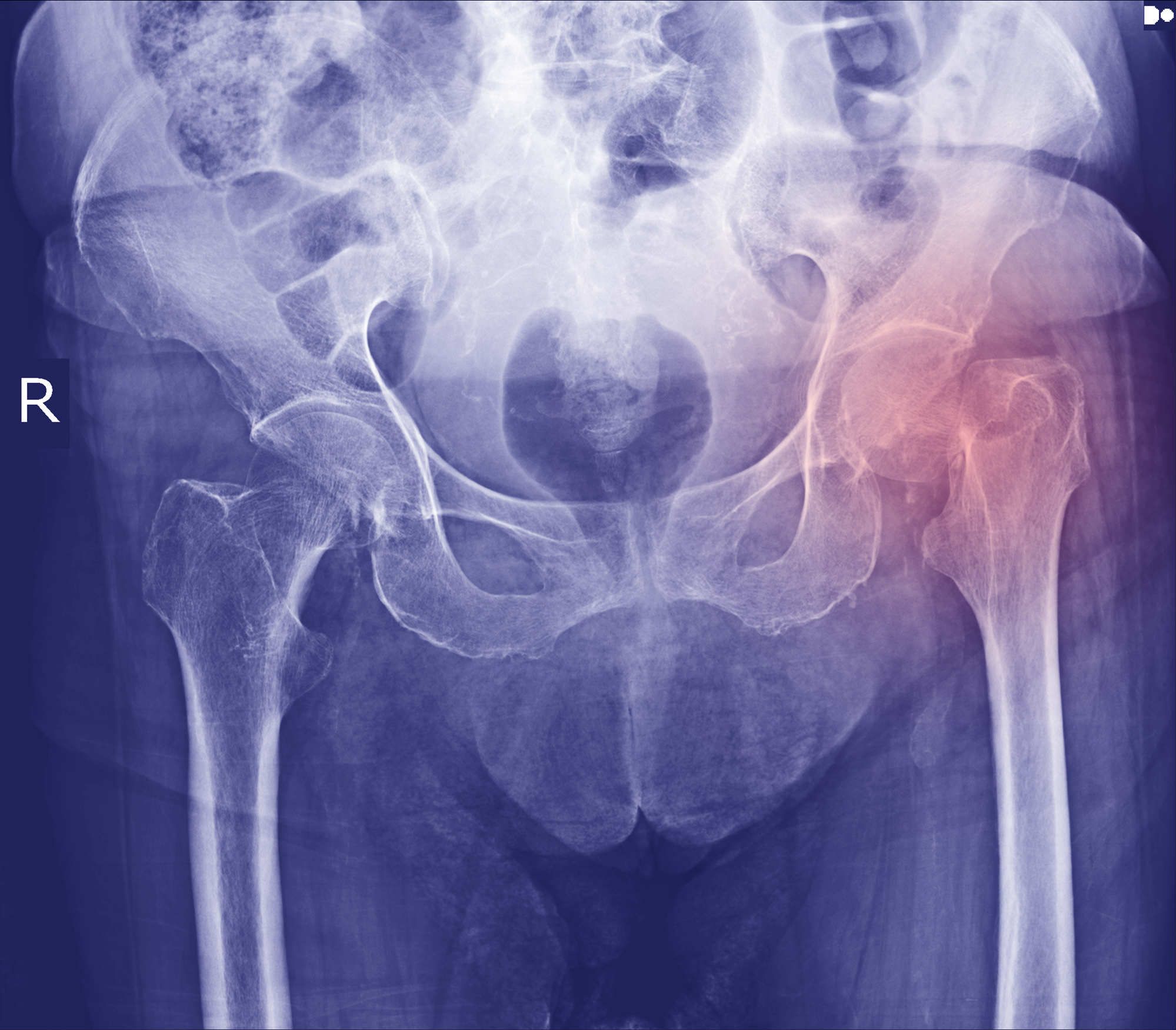DePuy ASR Metal On Metal Hip Replacement Allegedly Prone To Failure ...
