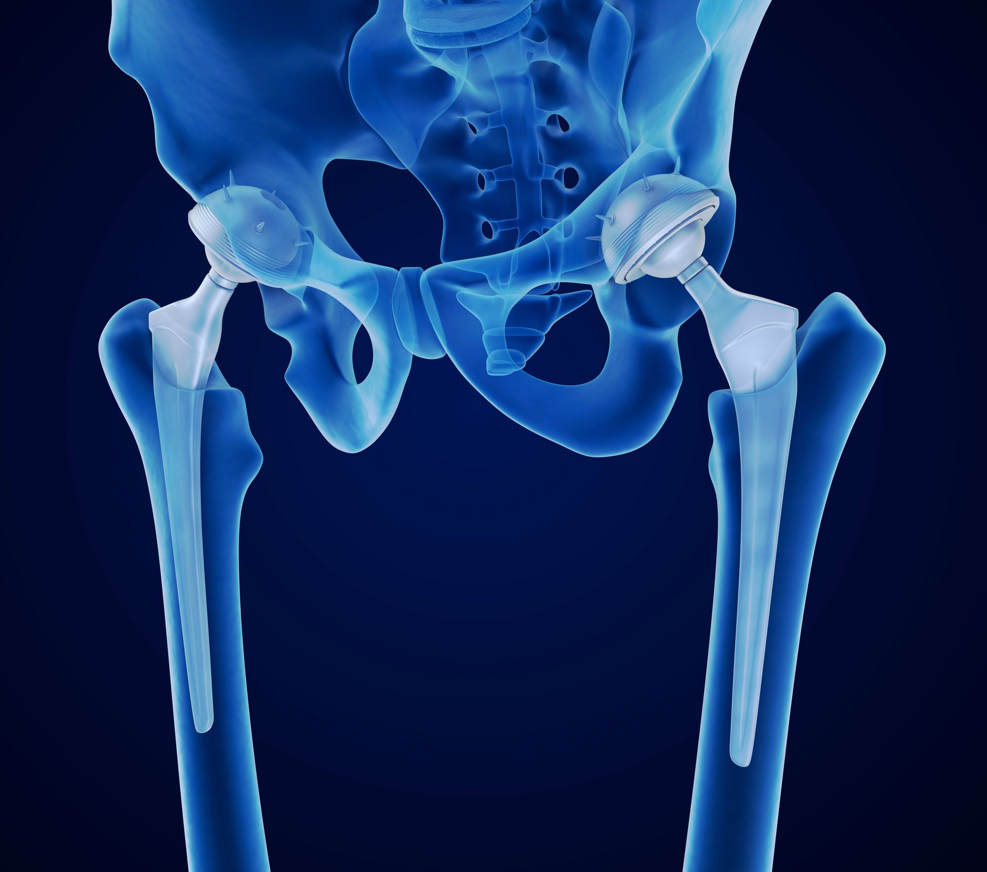 Patients Claim Manufacturer Responsible for DePuy Hip Implant Failure ...