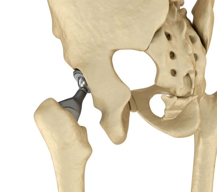 Patients in MDL Allege Problems with DePuy ASR Hip Replacement - Top ...