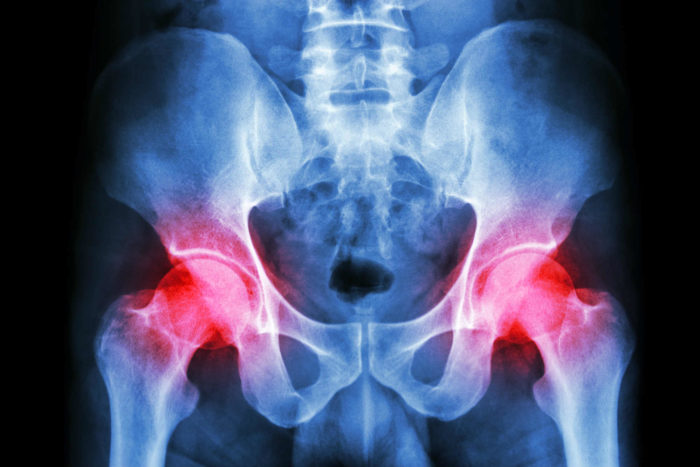 Patient Claims Zimmer Biomet M2a Magnum Hip Replacement is Defective