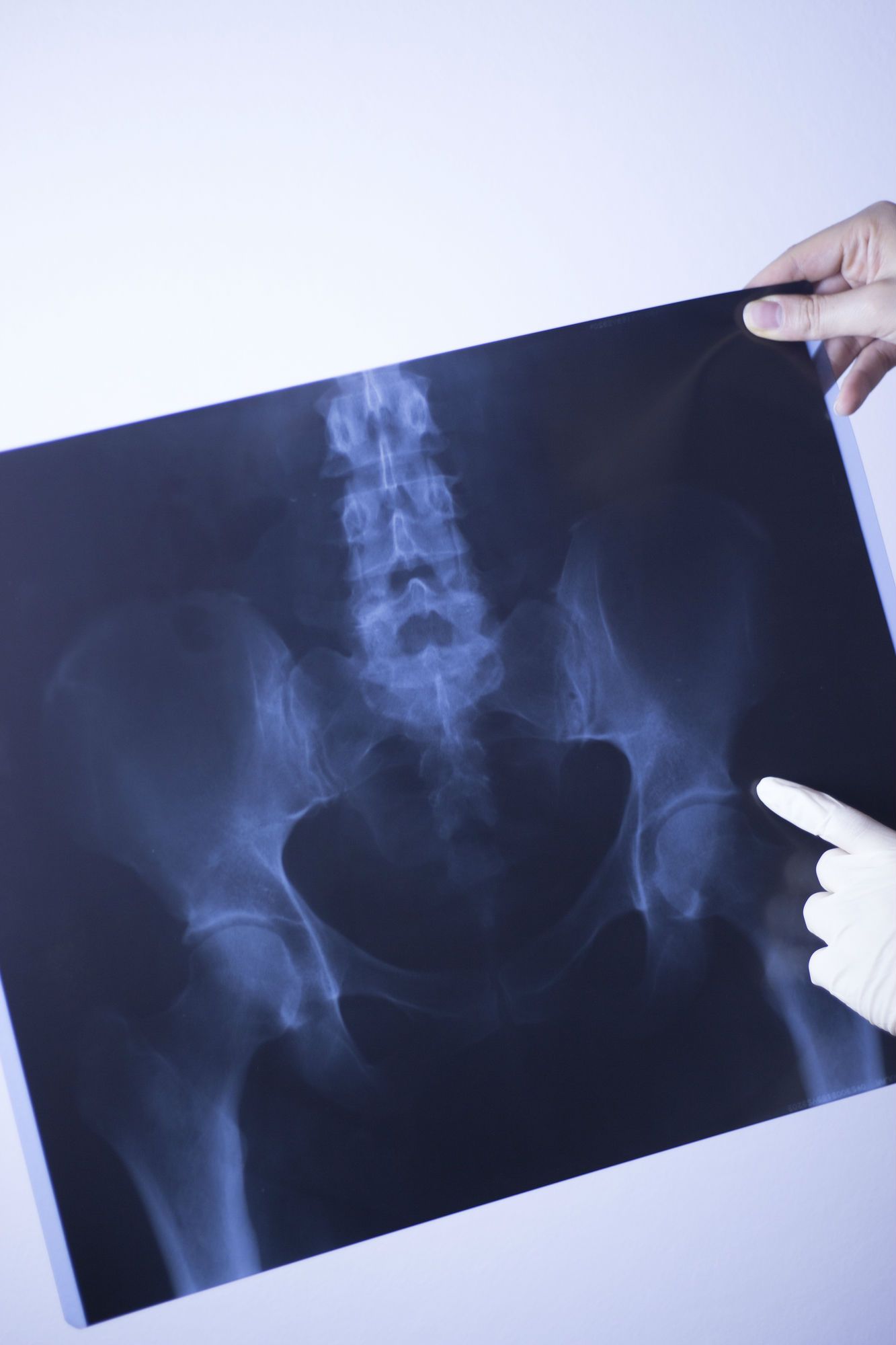 A New Patient Joins Multidistrict DePuy Pinnacle Hip Lawsuit - Top ...