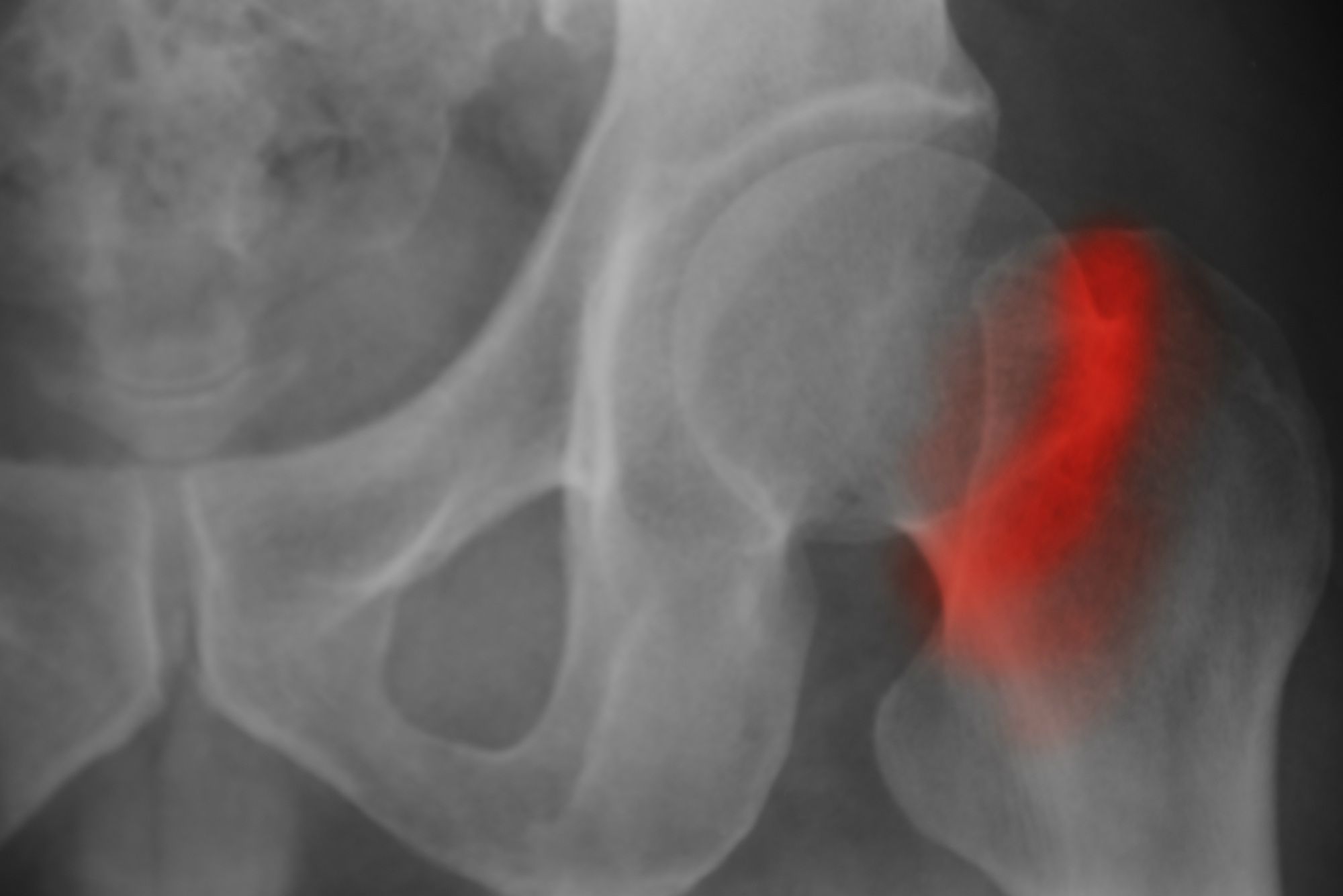 DePuy Pinnacle Implant Lawsuit Alleges Metal-on-Metal Design Led to ...