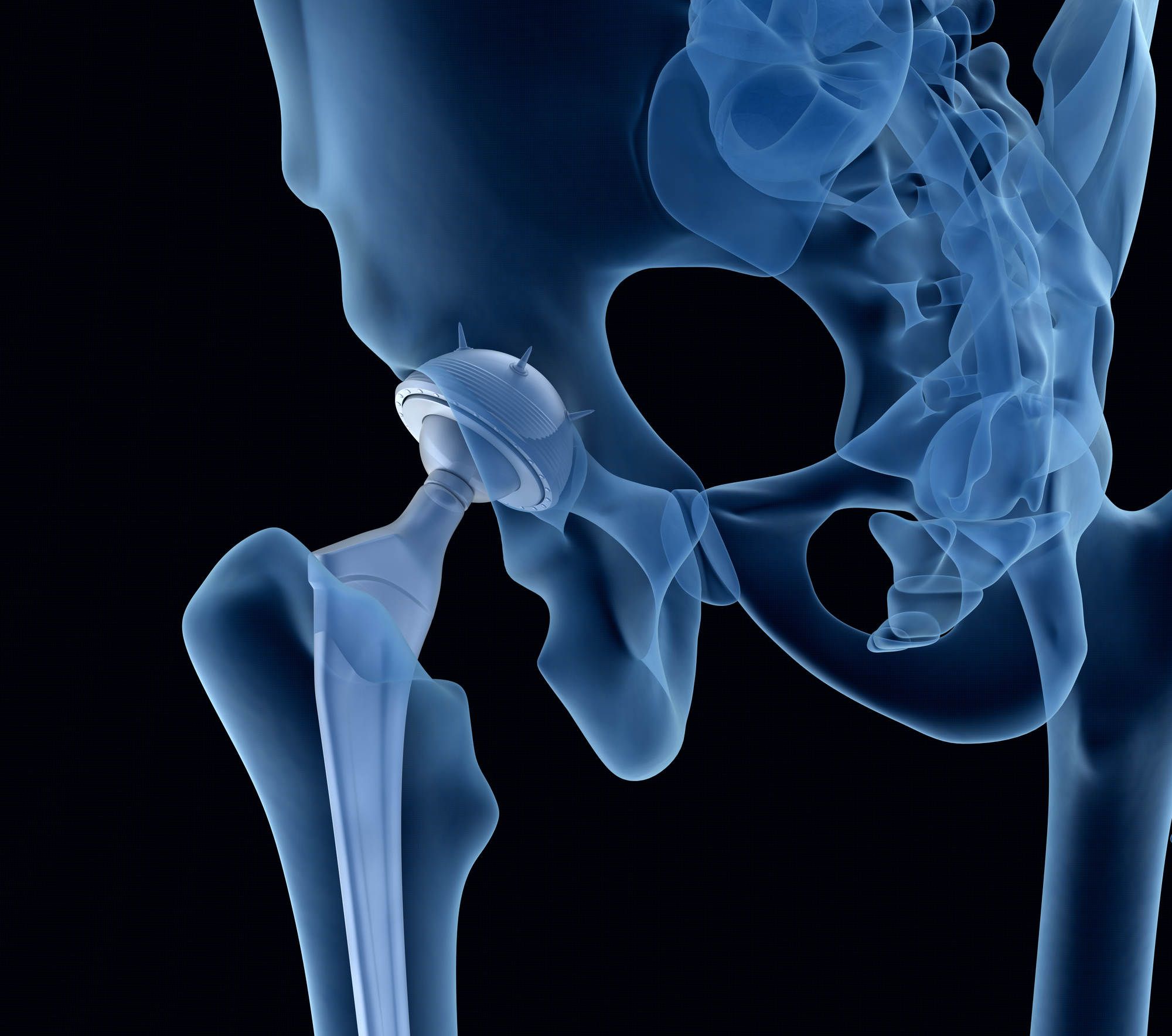 Man Files Pinnacle Hip Implant Lawsuit over Severe Adverse Side Effects ...