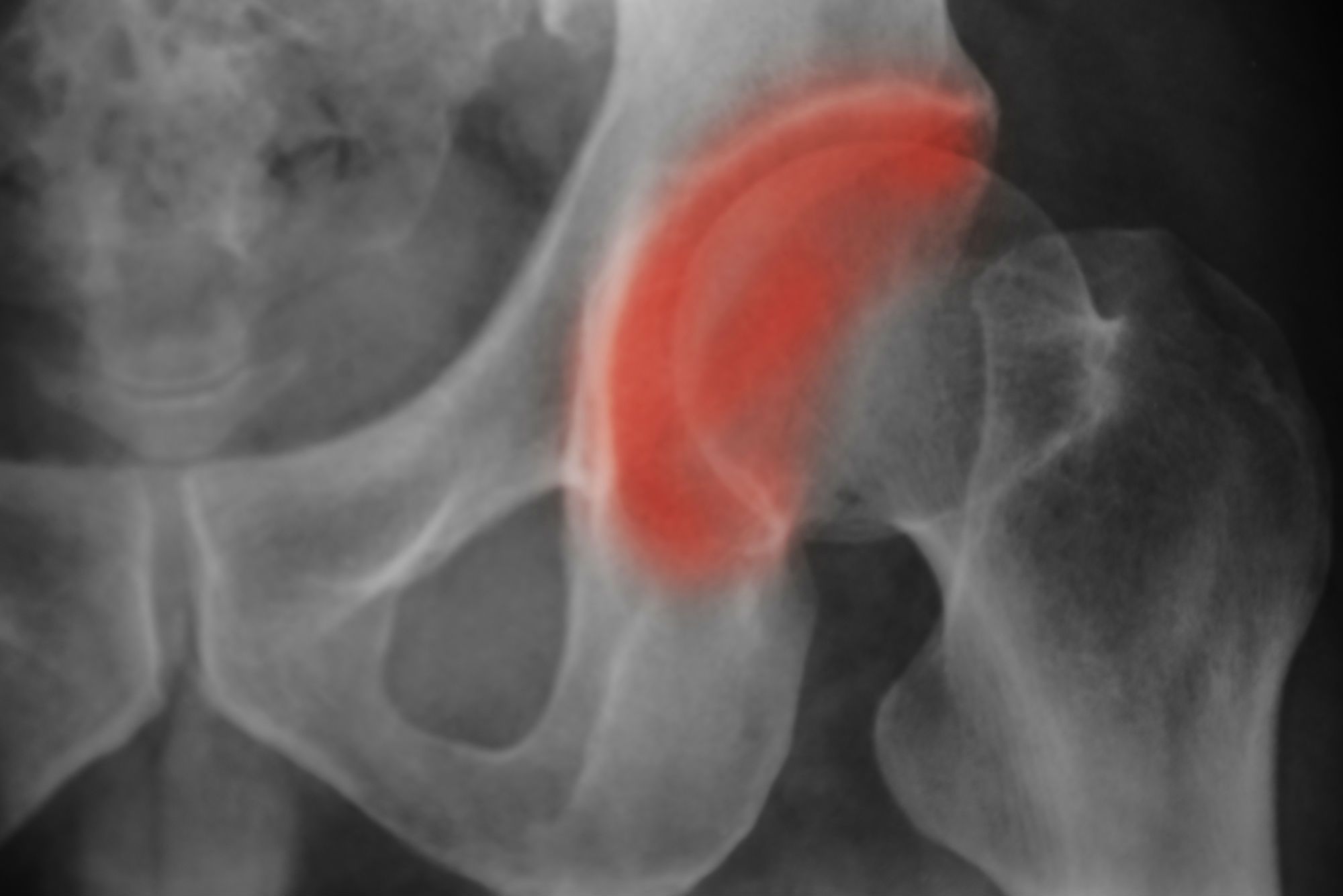 Claimant Alleges Serious Injuries From DePuy Hip Replacement Failure ...
