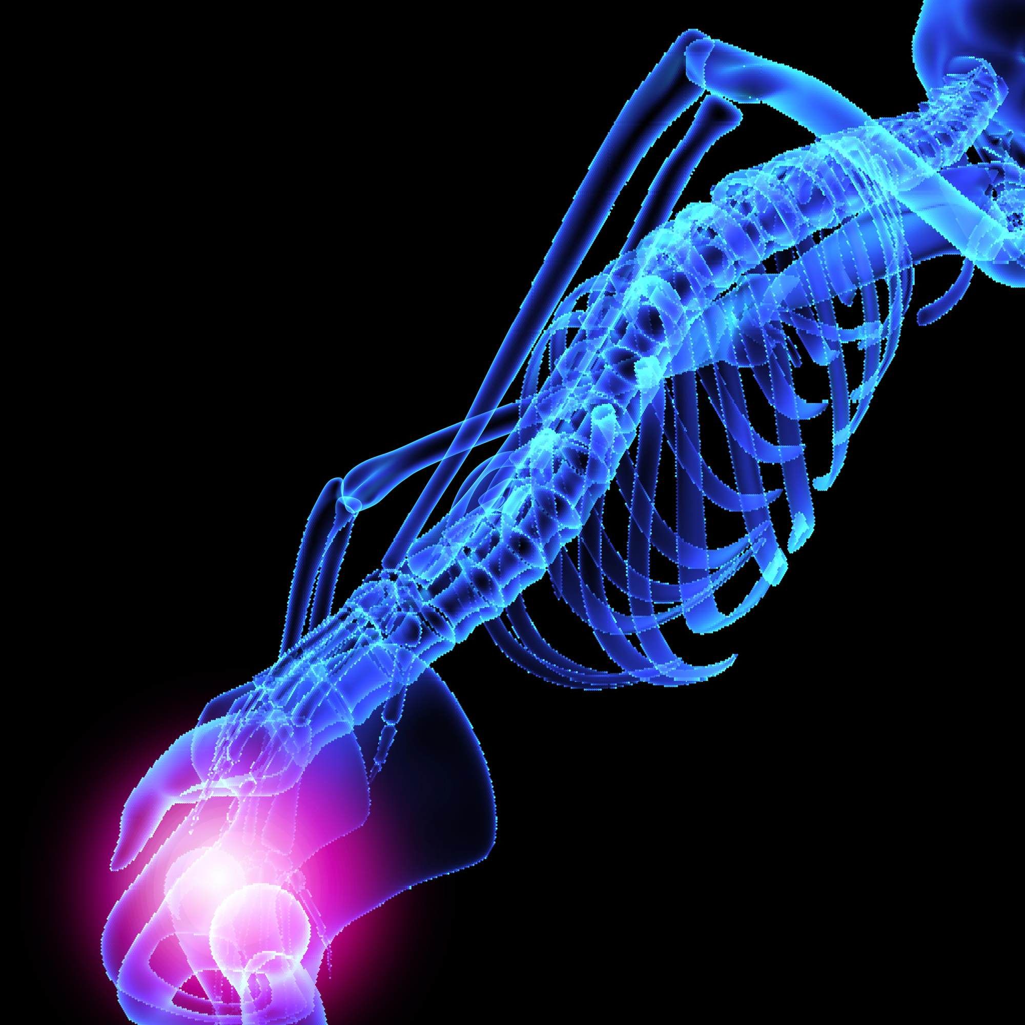 DePuy ASR Hip Recall Lawsuit Says Hip Replacement Caused Injury
