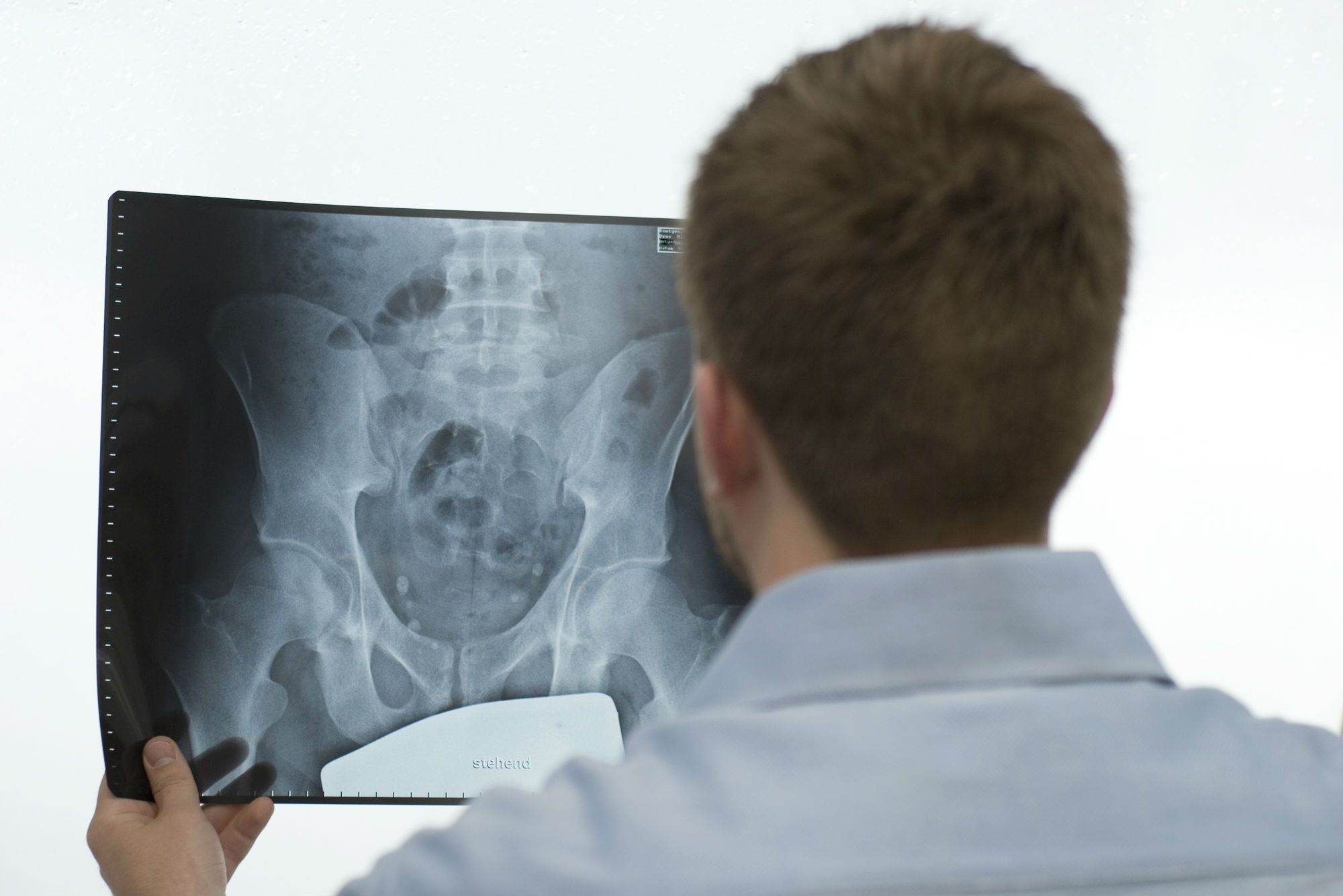 DePuy Hip Replacement Problems May be Linked to Materials Used - Top ...