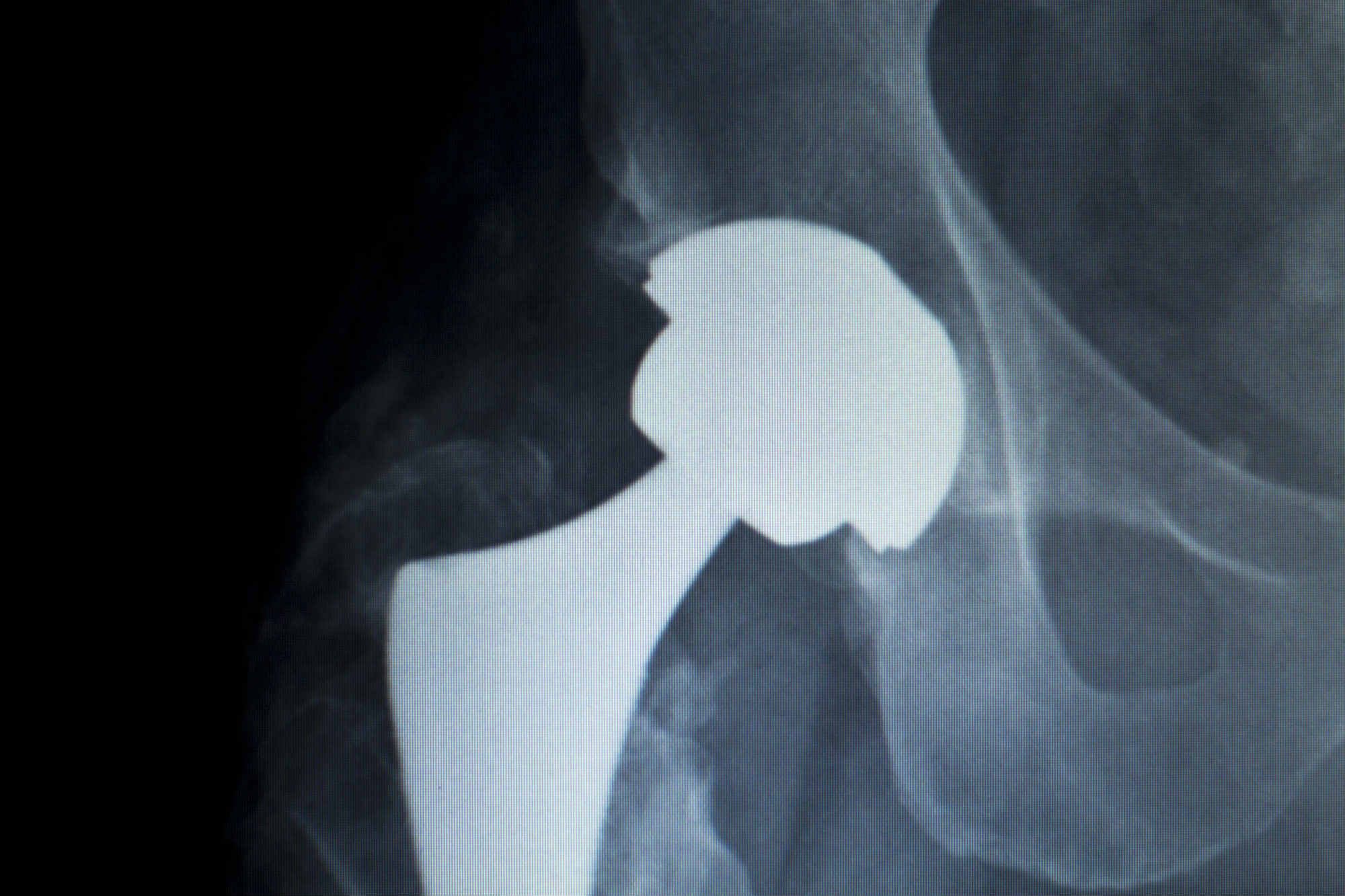Payouts for Hip Replacements