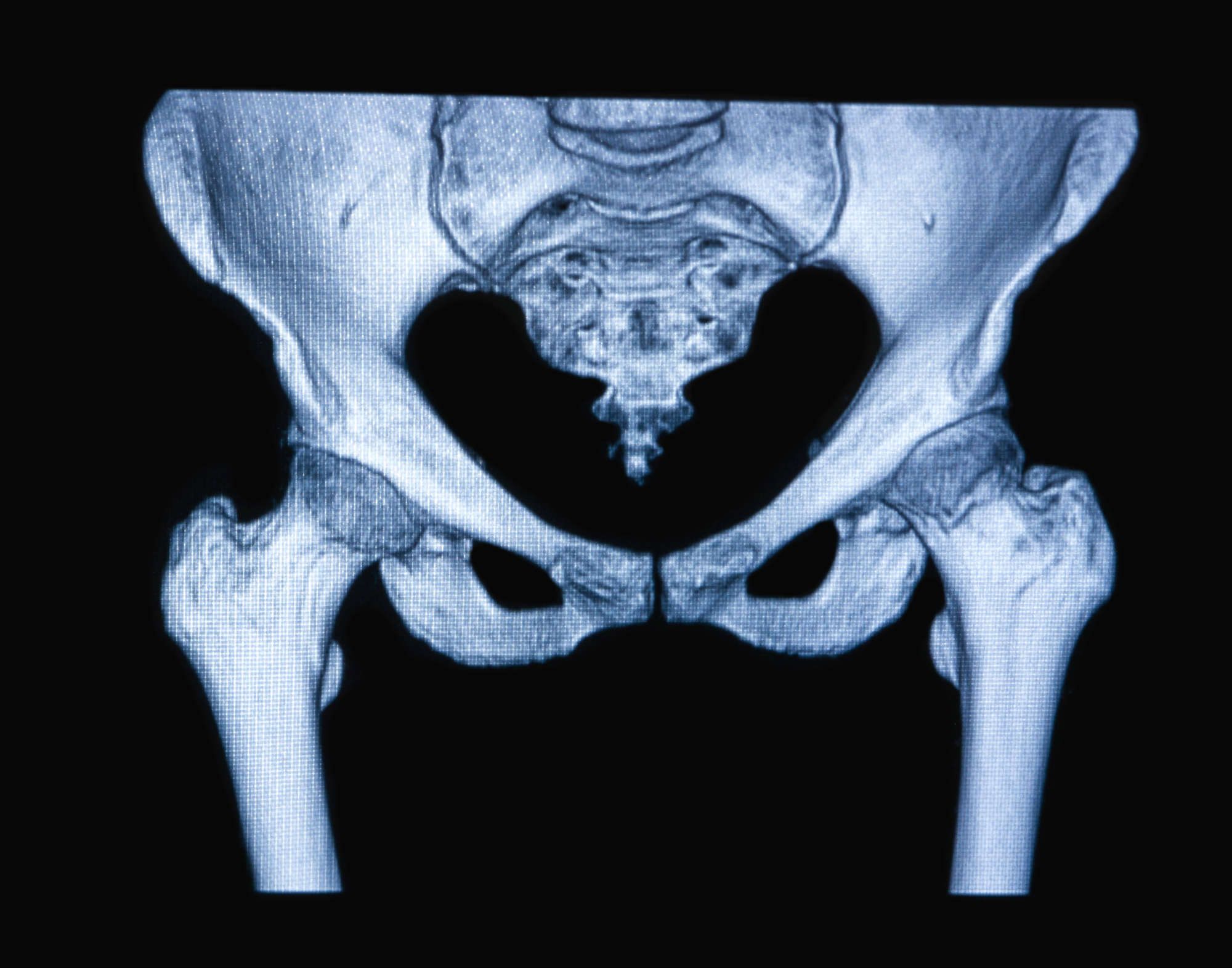 Metal on Metal Hip Implant Controversy - Top Class Actions