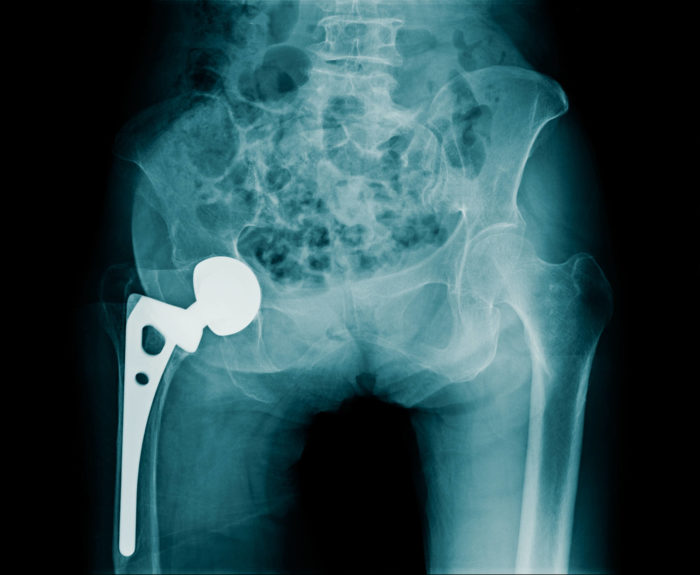 DePuy ASR Hip Replacement Recall Examined