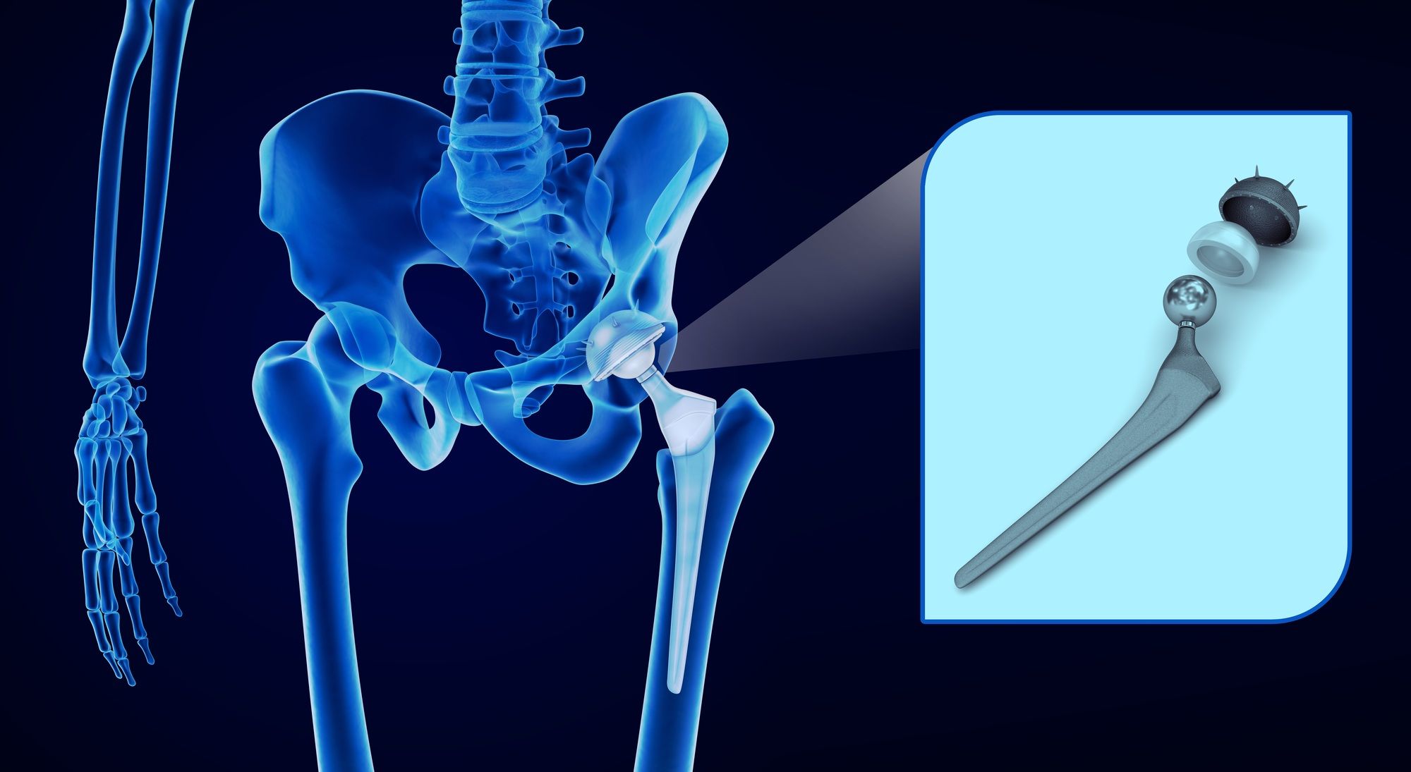 Hip Implant Lawsuit Says Metal-on-Polyethylene Implant Caused ...
