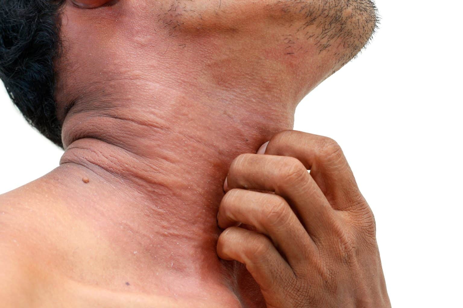 What are the symptoms of Stevens Johnson Syndrome?